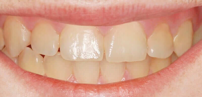 Icon White Spot Treatment in Sutton Coldfield & Solihull